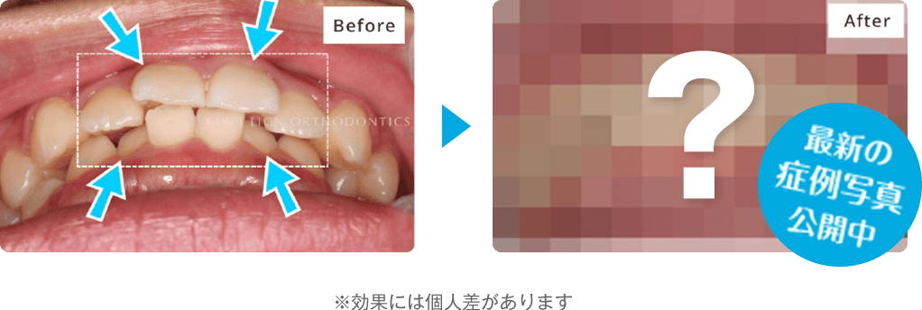 【やばい?】キレイライン矯正の口コミ評判「最悪・怪しい」は嘘?ツイッター・知恵袋で調査!メンズキレイライン・キレイラインキッズも!